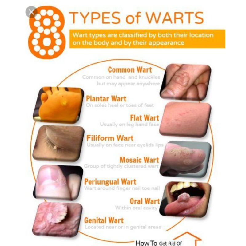 Difference Between Genital Warts And Skin Tags Difference Between Genital Warts And Skin Tags